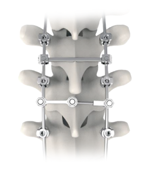 Silver Posterior Thoracolumbar Fixation System