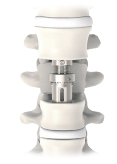 Zek Anterior Thoracolumbar Corpectomy Cage